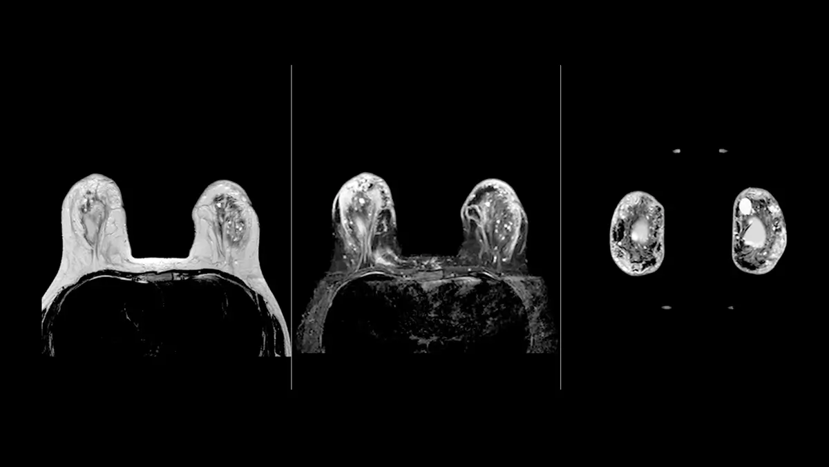 What to Expect During a Breast MRI and How to Prepare for It | DRI